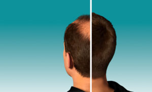 Different Types of Hair Transplant - Crown Clinic